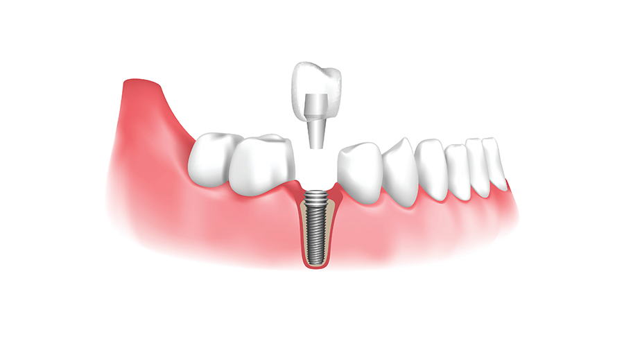 Dental Implants in Boca Raton, FL | Dental Implants Near Me